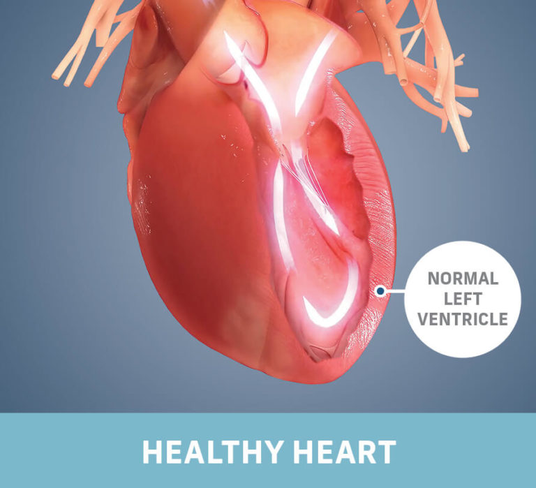 Patients | Heart Failure Treatment | Ancora Heart